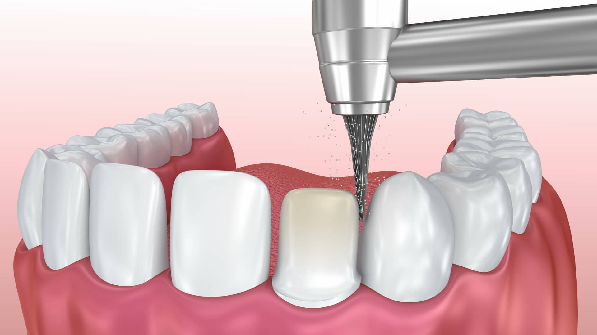 25204556-hd-Dental Veneers Porcelain Veneer installation Procedure 3D ...