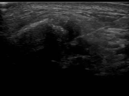 Ultrasound guided 1st CMC joint injection on Vimeo