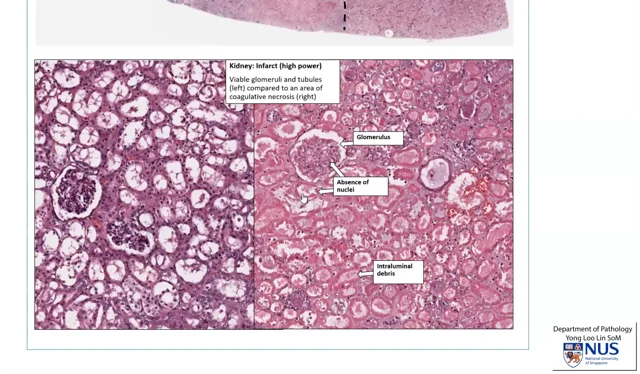 Pale Infarct Kidney