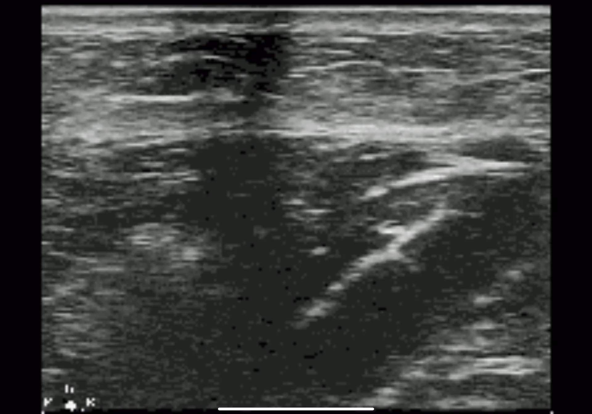 The Swirl Sign Can Identify A Subtle Abscess on Vimeo