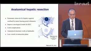 Laparoscopic anatomical segmentectomy with ICG fluorescence staining ...