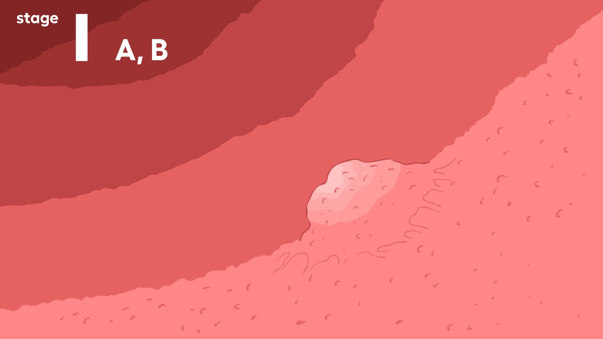 Lung Cancer Staging Lung Cancer Staging Stage I On Vimeo