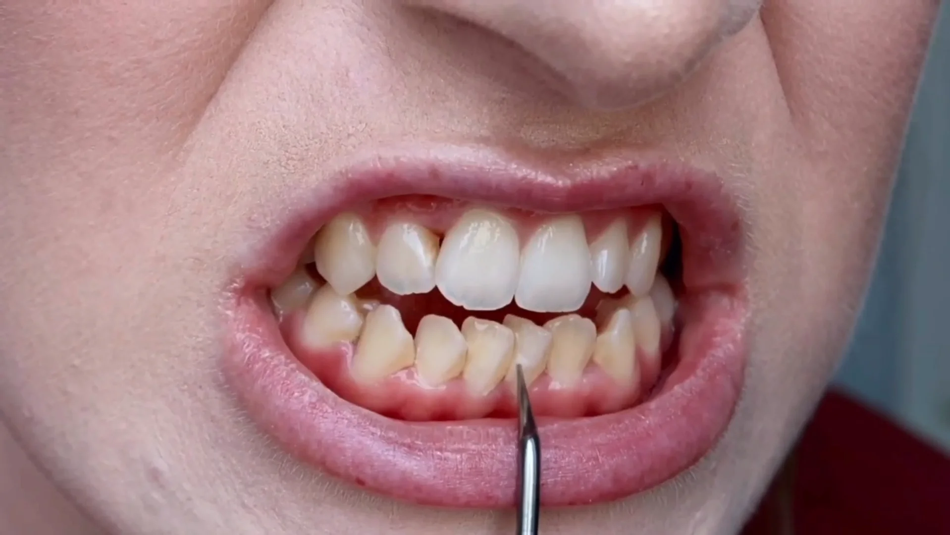 TWINKLE TEETH© - ULTRASONIC TOOTH CLEANER