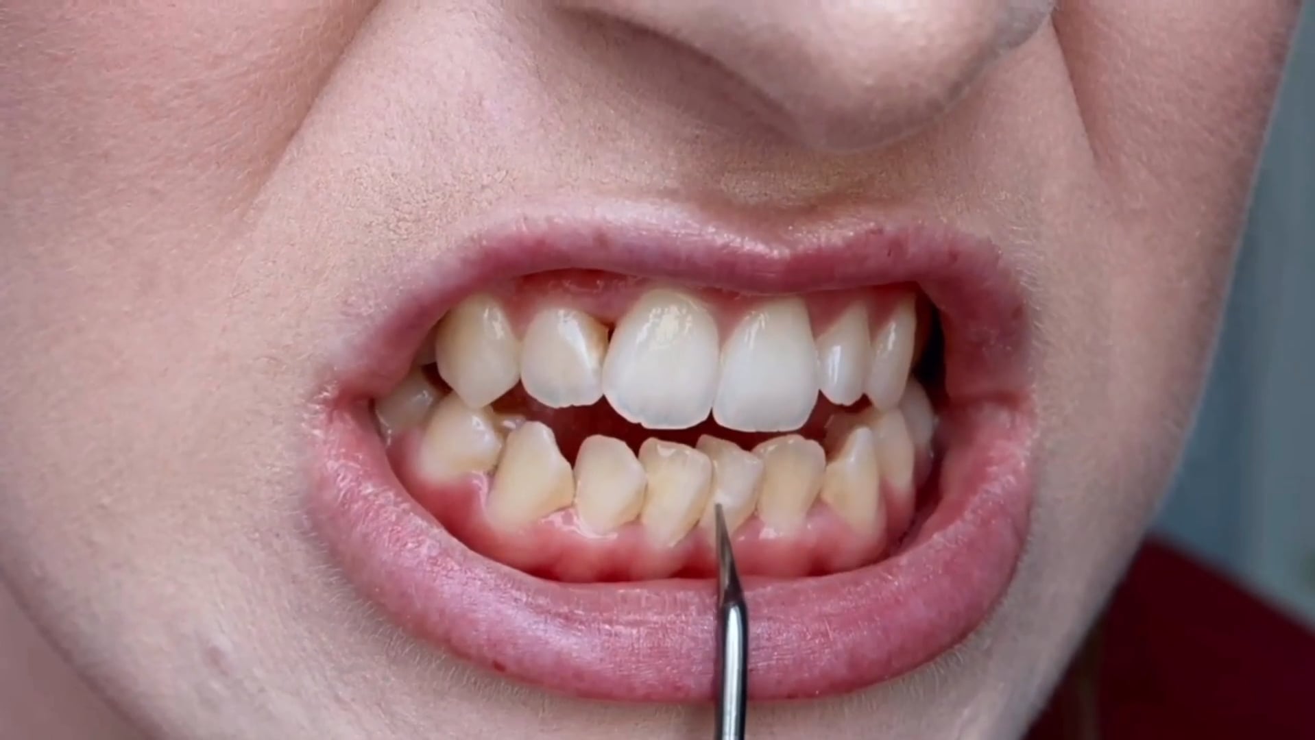 TWINKLE TEETH© - ULTRASONIC TOOTH CLEANER
