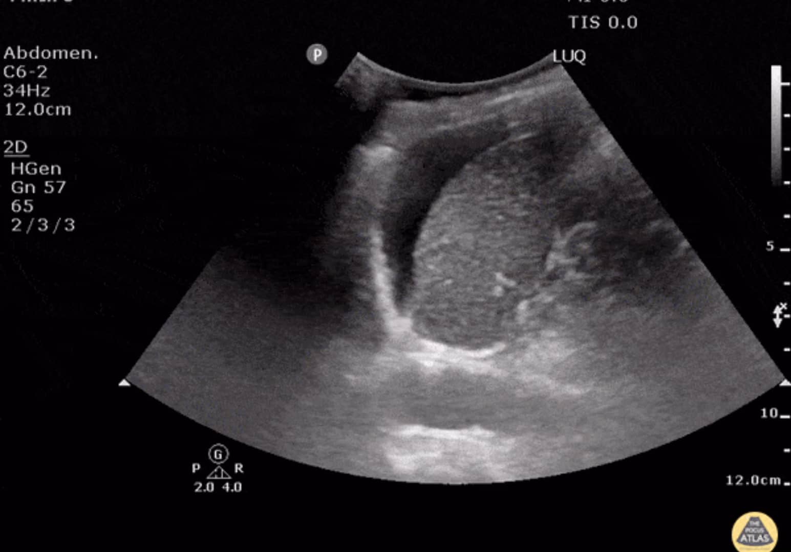 Positive FAST in LUQ View on Vimeo