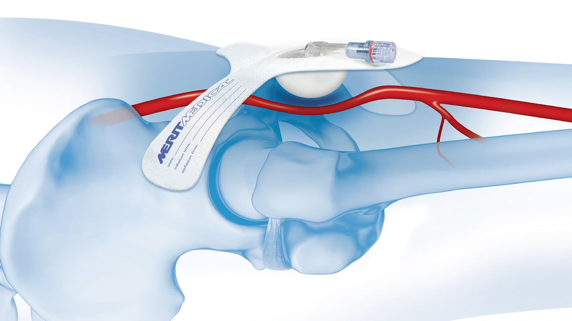 SafeGuard Compression Device [In-Service] on Vimeo