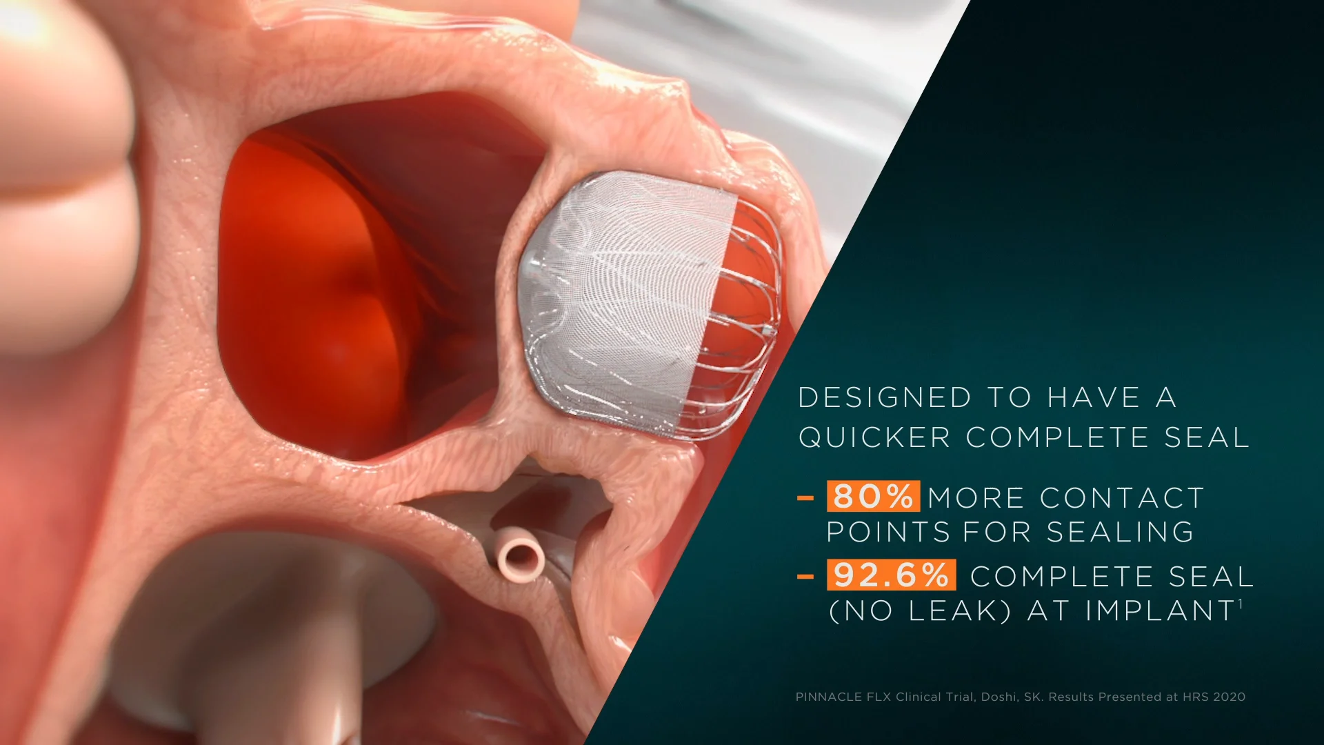 WATCHMAN FLX™ Device Animation: Implant Technique