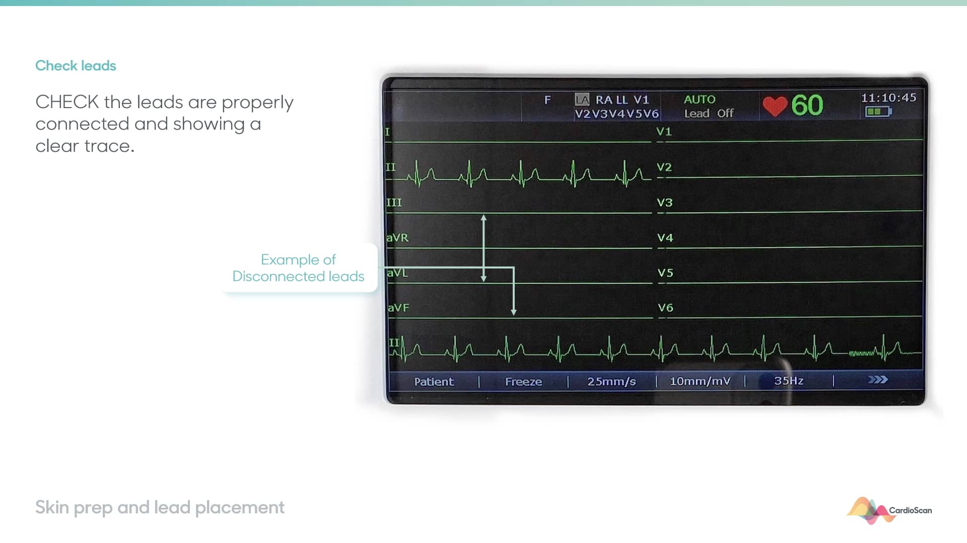 ECG Training Modules - Skin prep and lead placement on Vimeo
