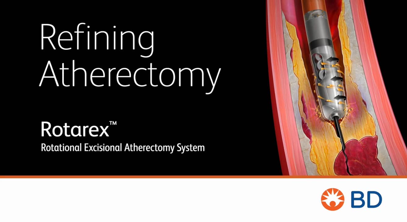 Rotarex Rotational Excisional Atherectomy System on Vimeo