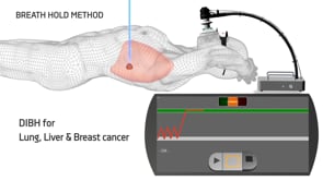The SDX® System: Unique respiratory gating system significantly ...