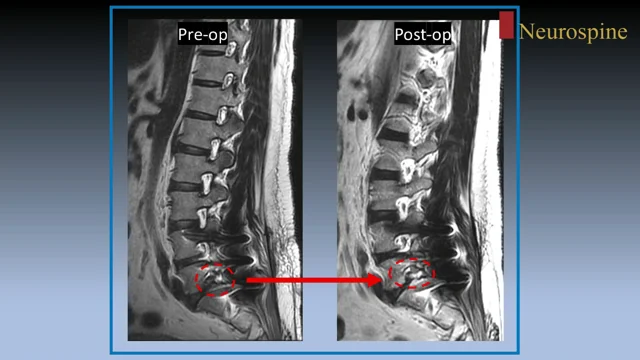 Ferguson View Of Lumbar Spine