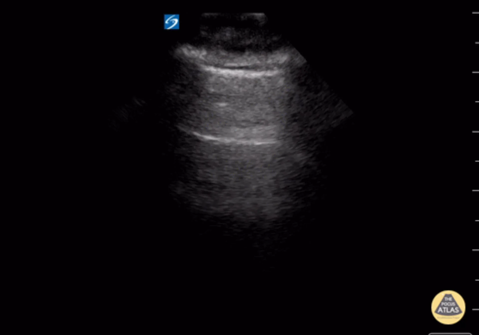 Normal Lung Ultrasound on Vimeo