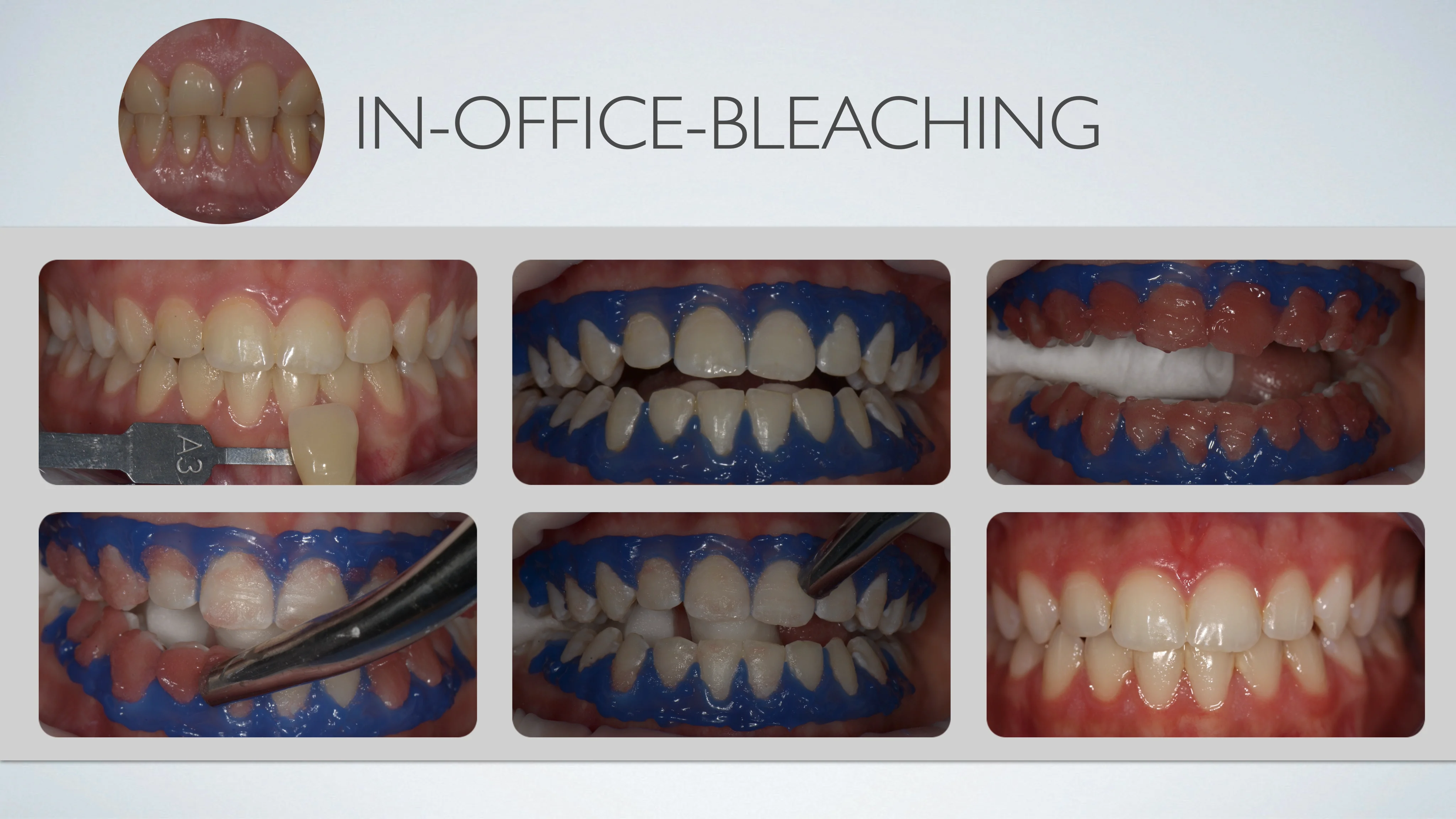 Online-Seminar: Dr. Pune Nina Paqué: Bleaching A-Z on Vimeo