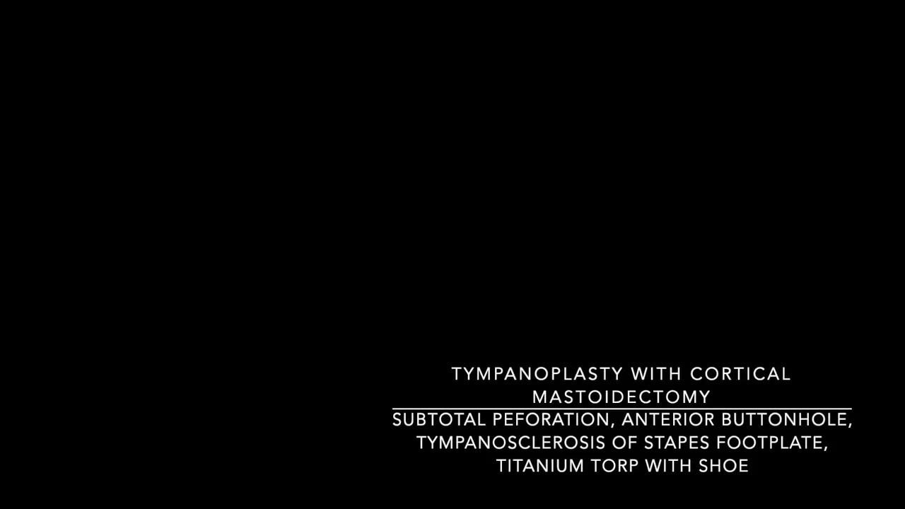 5.2 Tympanoplasty, Subtotal perforation, Cortical mastoidectomy ...