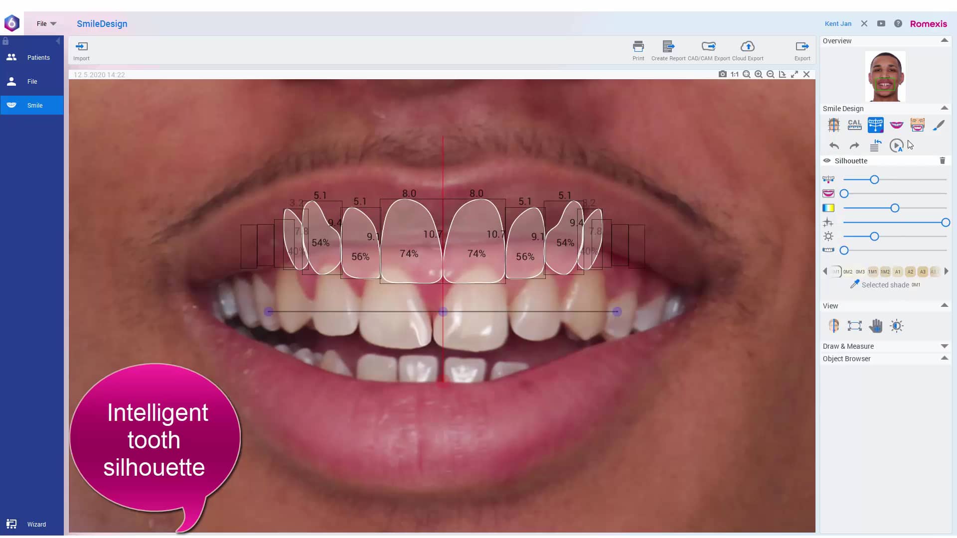 Romexis Smile Design 6 in 2 Minutes on Vimeo
