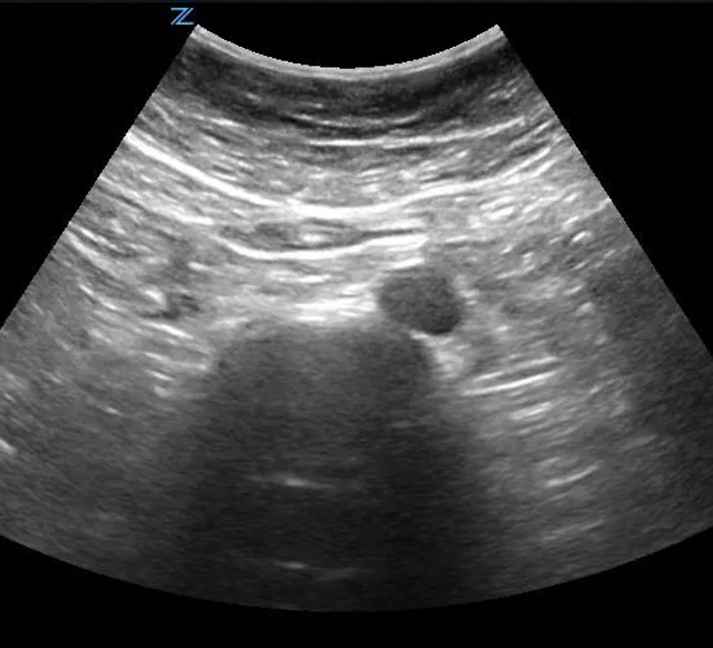 Ruptured Abdominal Aortic Aneurysm Ultrasound