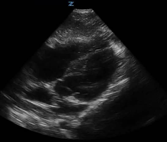 Cardiac Video 1. Normal Subxiphoid View on Vimeo