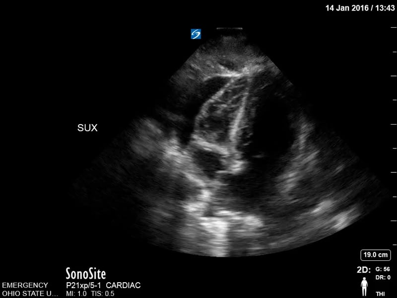 Cardiac Video 9. Subxiphoid View of Pericardial Effusion with Cardiac ...