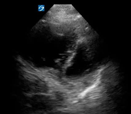 Cardiac Video 13. Parasternal Short Axis View with D Sign