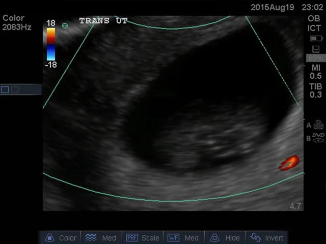 Intrauterine Ultrasound