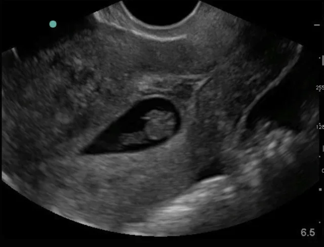 6 Week Transvaginal Ultrasound
