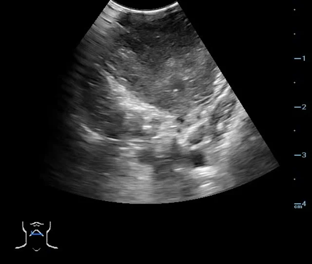 Submandibular Abscess Ultrasound