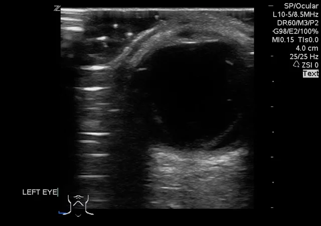 Eye Ultrasound