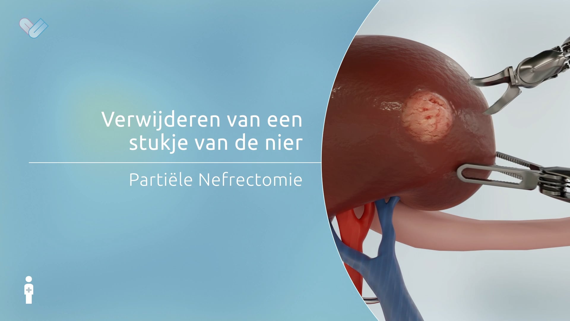 01_0040_Partiële_Nefrectomie on Vimeo