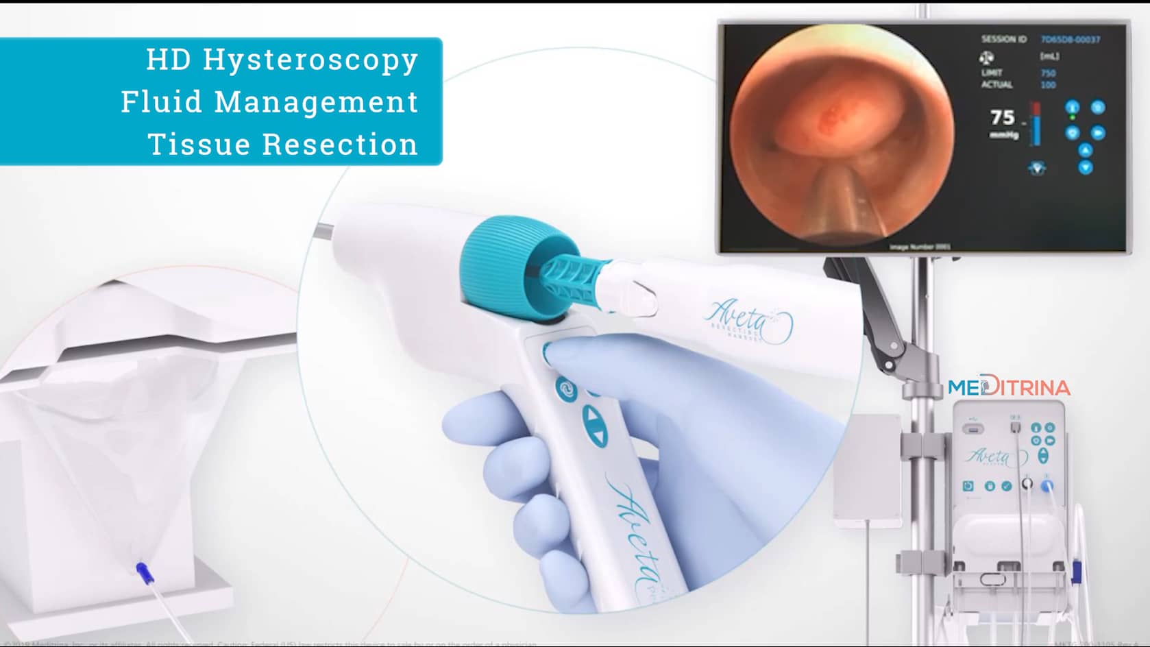 Dr. David Lubetkin, M.D., FACOG, performs a hysteroscopic polypectomy ...