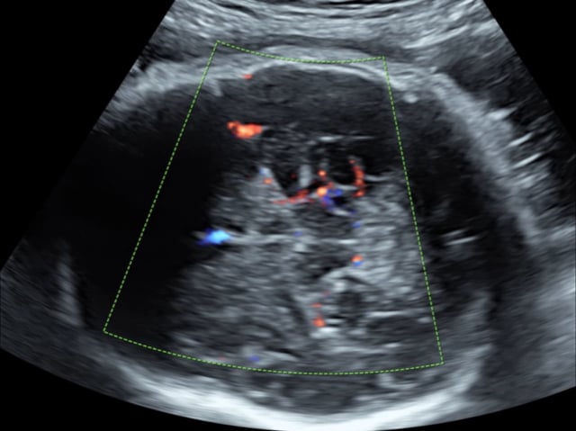 Obstetric Dopplers – ULTRASOUNDPAEDIA