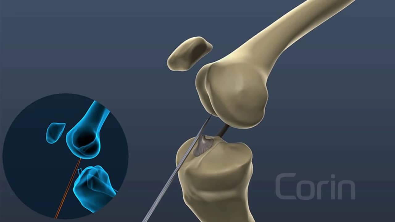 2. Técnica LARS en Traumatología Humana por CORIN Group on Vimeo