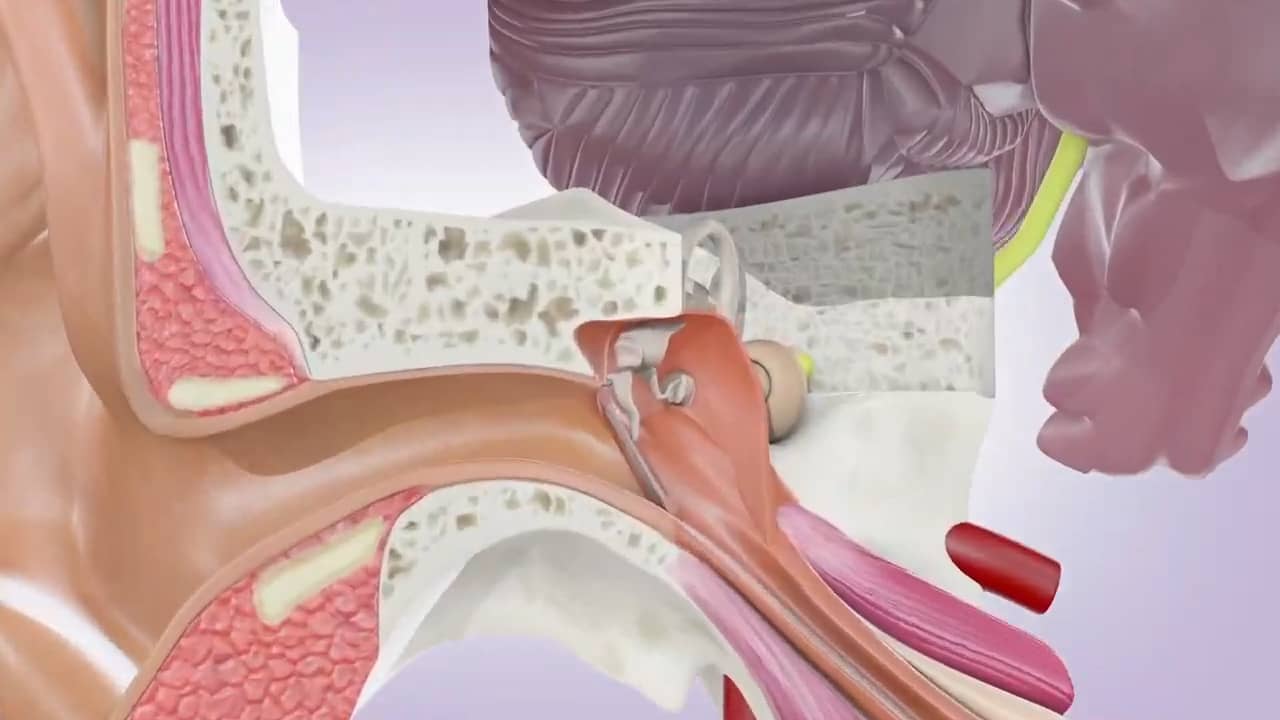 Conditions_BPPV Canalithiasis on Vimeo