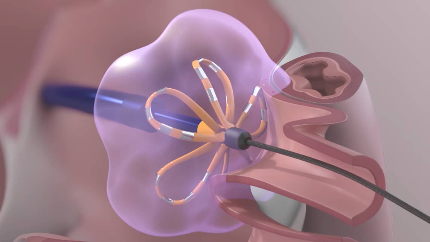 Farawave Ablation Procedure on Vimeo