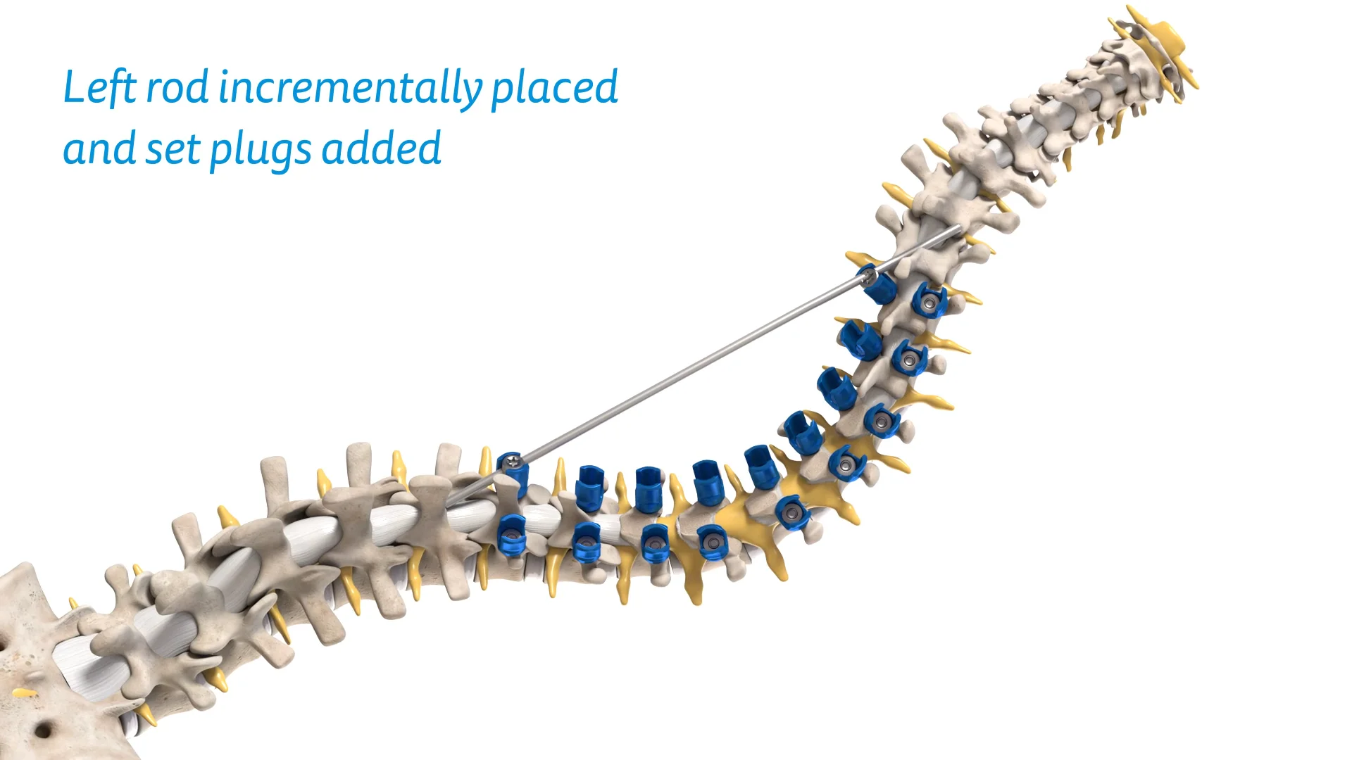 Posterior Column Osteotomy for Scoliosis