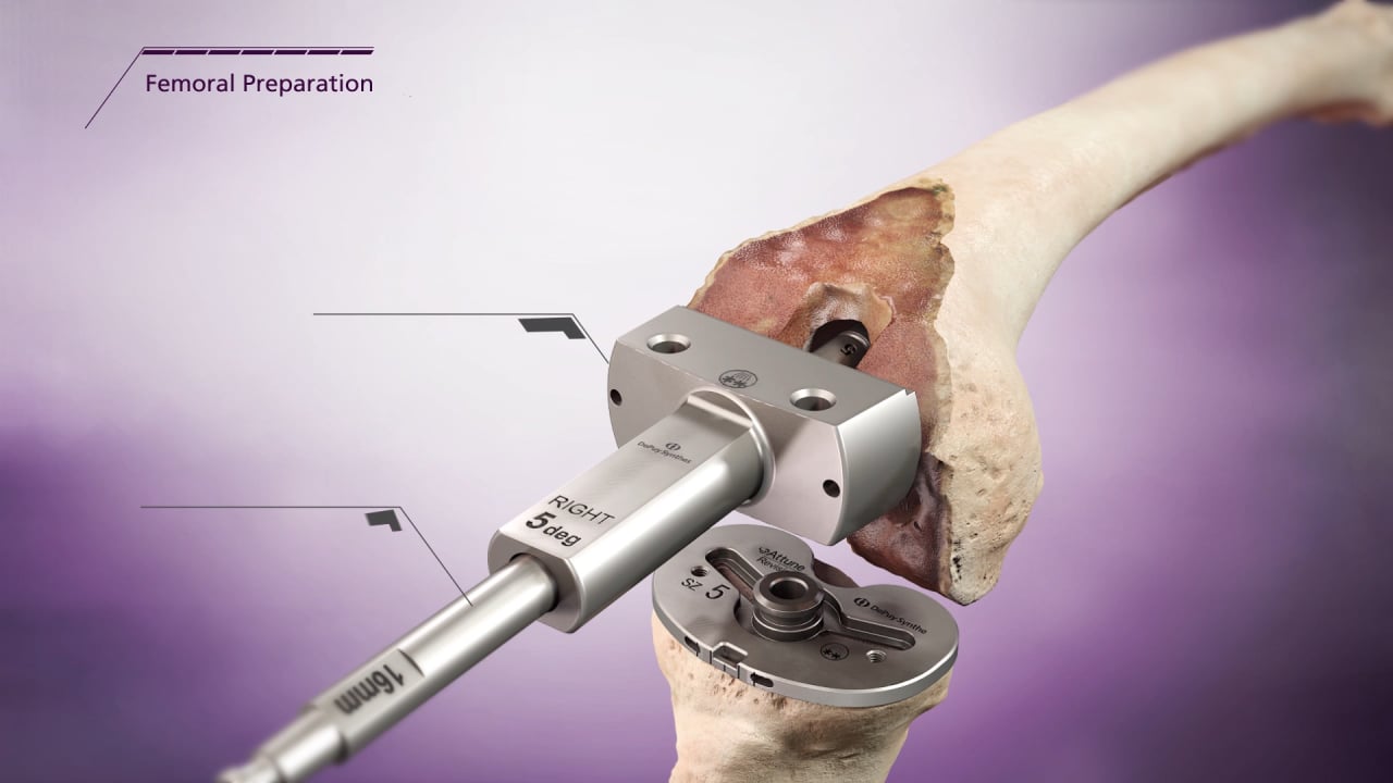 ATTUNE Rev RP Tibial and Femoral Sleeves on Vimeo