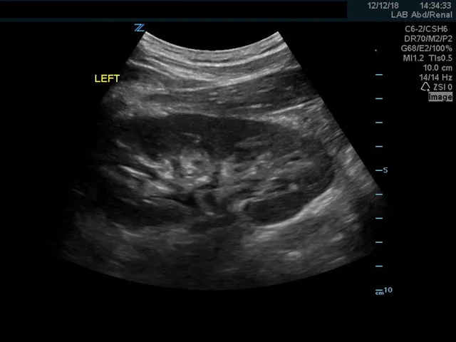 Kidney Ultrasound Images Normal