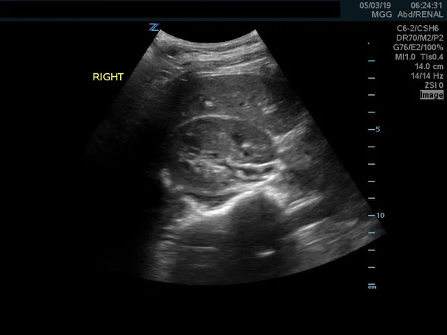 Kidney Ultrasound Images Abnormal