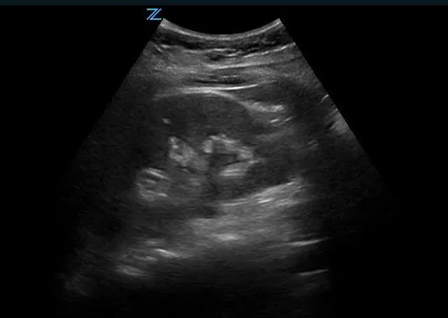 Kidney Ultrasound Images Normal
