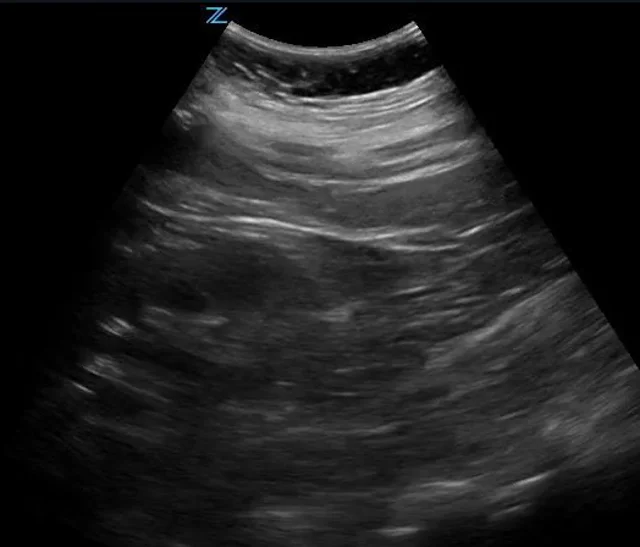 Kidney Ultrasound Images Normal