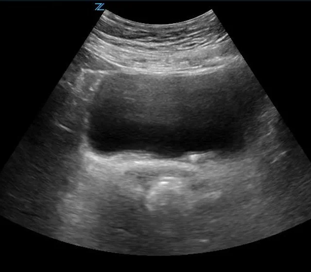 Extrarenal Pelvis Ultrasound