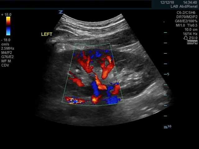 Kidney Ultrasound Images Abnormal