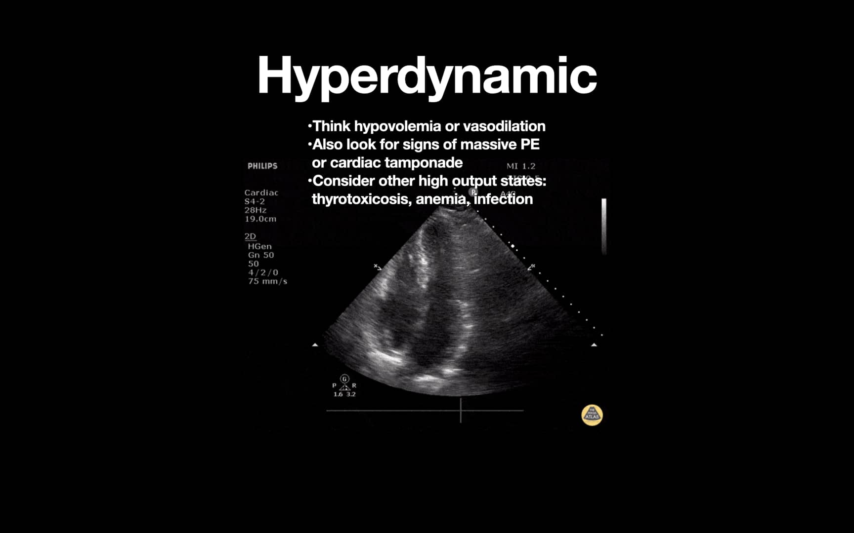 Hyperdynamic Left Ventricle on Vimeo