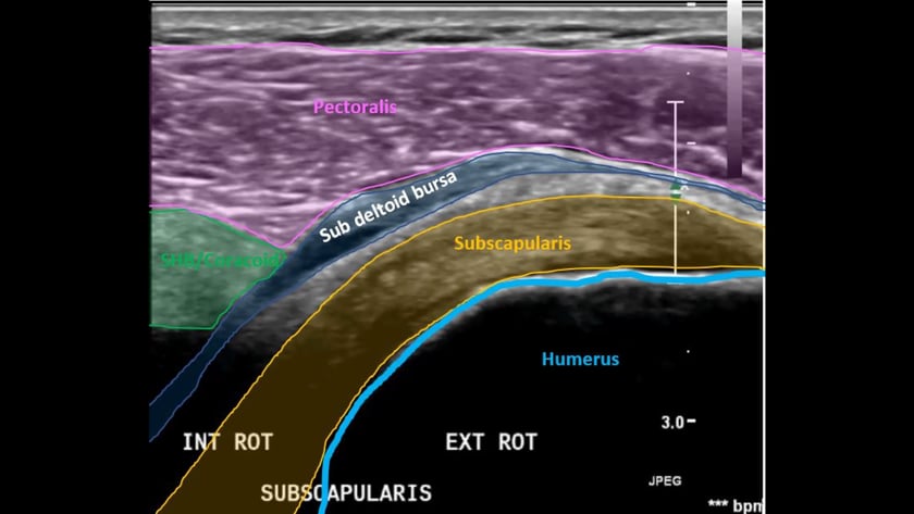 Shoulder pathology – ULTRASOUNDPAEDIA
