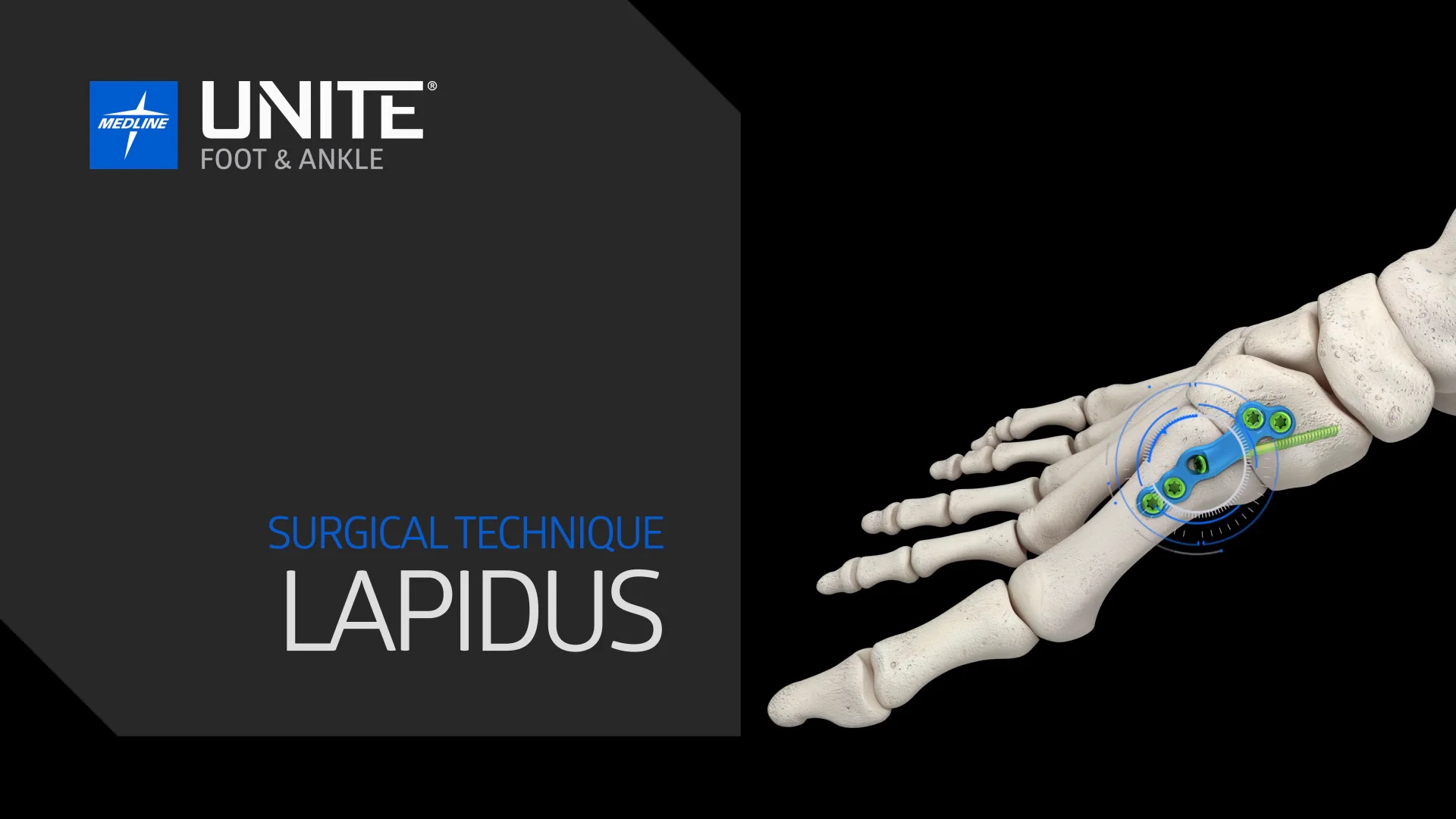 Lapidus Dual-Mode Compression Surgical Technique on Vimeo