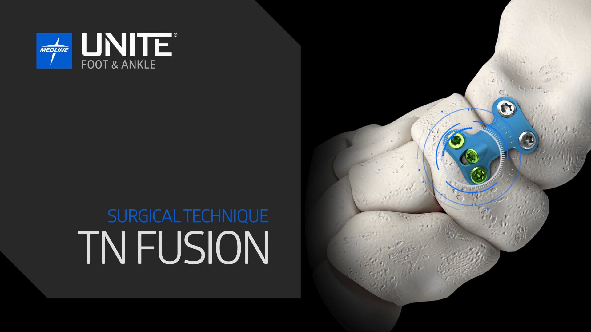 TN Fusion Surgical Technique
