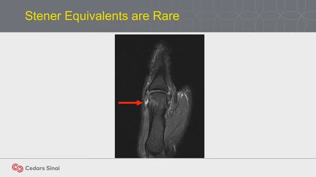 Radial Collateral Ligament Thumb Mri