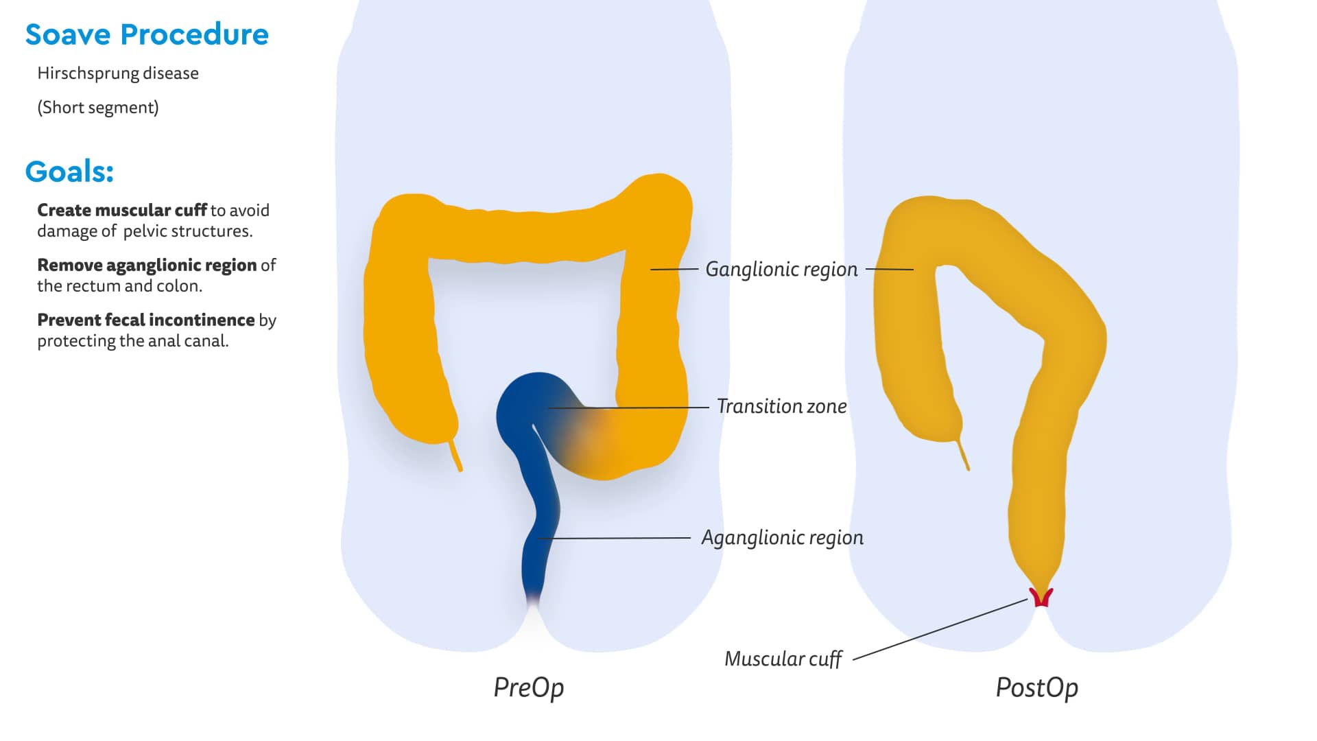 The Soave Procedure (Transanal approach) for Rectosigmoid Hirschsprung ...