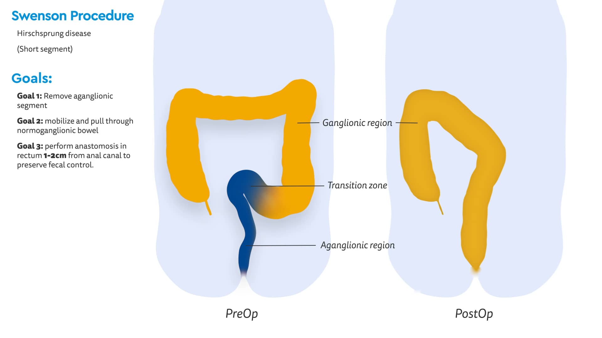 The Swenson Procedure (Transanal approach) for Rectosigmoid ...