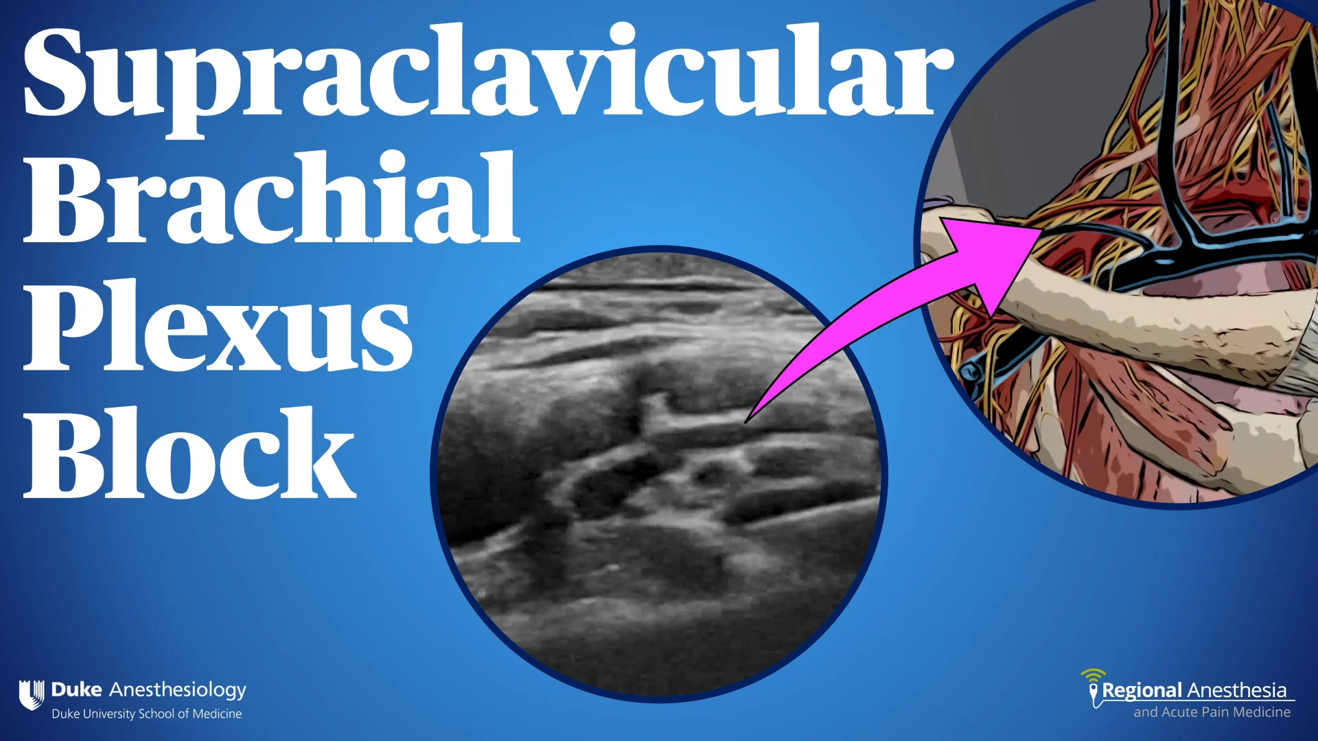 Supraclavicular Nerve Block