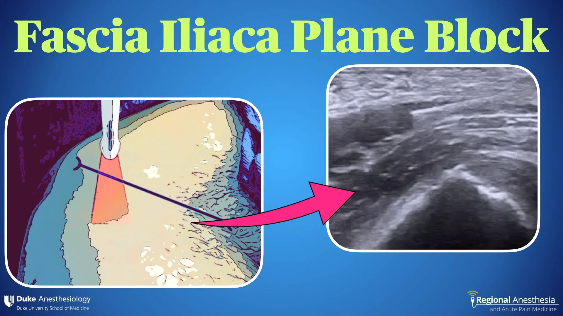 Suprainguinal Fascia Iliaca Block on Vimeo